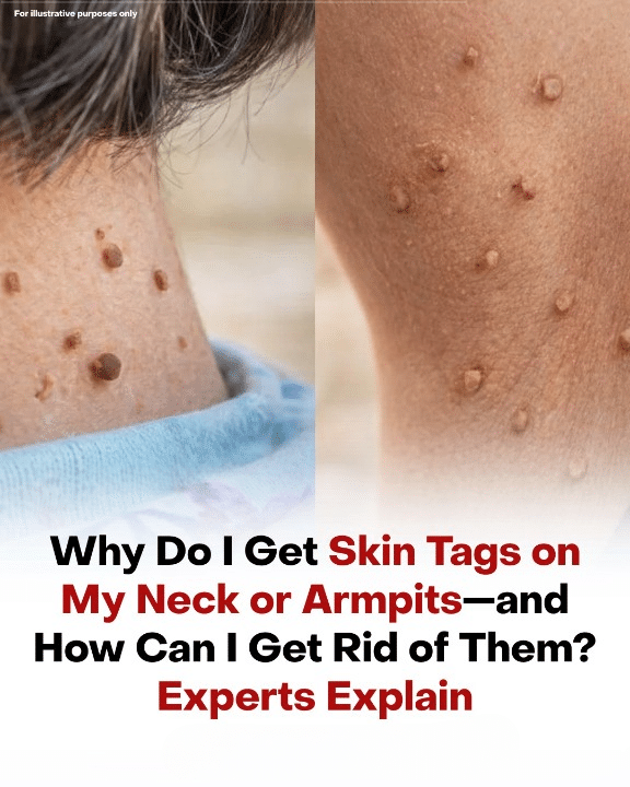 Why Do Skin Tags Show Up on the Neck or Armpits—and How Can You Remove ...