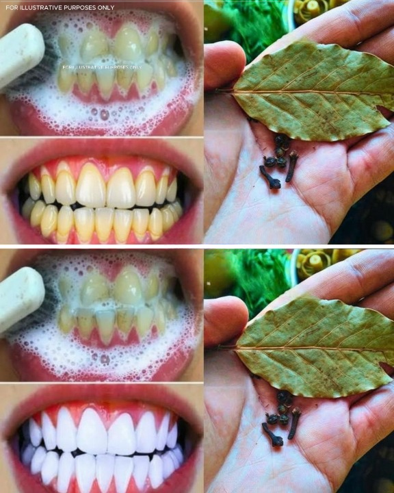 Brightening Teeth with Bay Leaves: Natural Help or Just a Myth ...