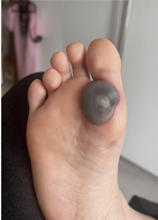 My daughter just woke up with a large spot on her foot, and I have no ...